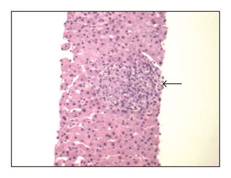 A Liver Biopsy With Hematoxylin And Eosin Stain Demonstrating A