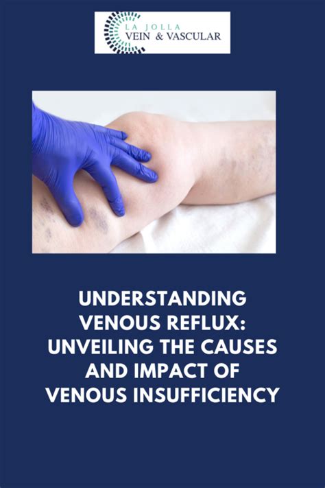 Venous Reflux Causes And Symptoms What You Need To Know