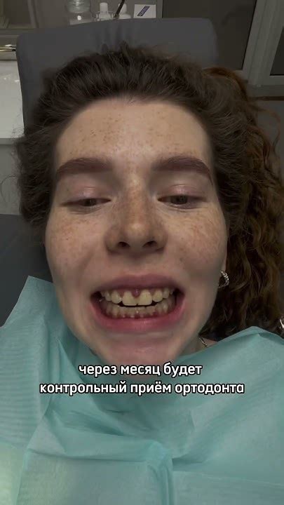 Брекеты до и после брекеты зубы энергия желание допосле Youtube