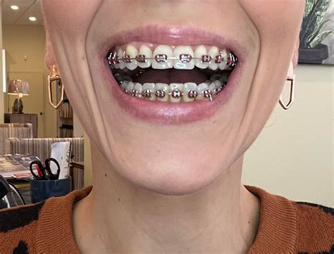Hi Update Braces Off In 23 Days Im So Happy And Excited I Cant