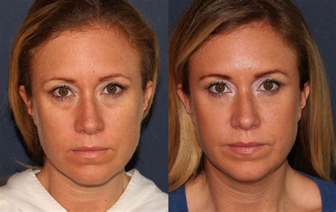 Top Restylane Medical Spa San Diego Ca Cosmetic Laser Dermatology