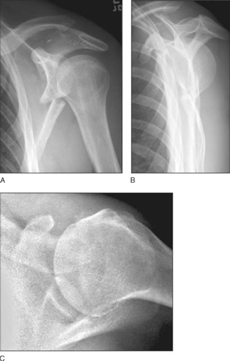 Glenoid Fossa Fracture