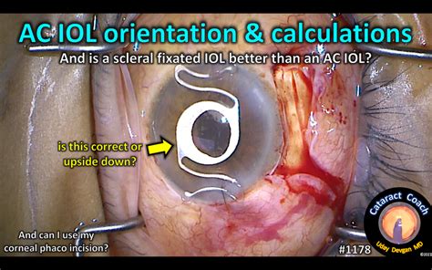 Iol Calculations Cataract Coach