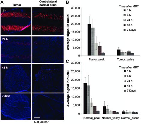 Gamma H2ax Staining On Irradiated Tumor And Normal Brain Tissue Panel