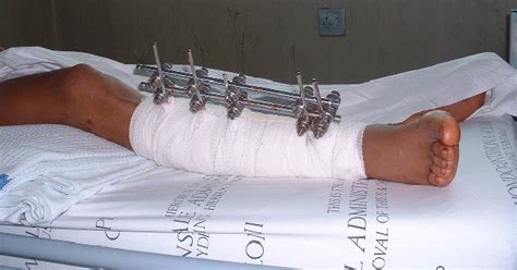Uniplanar Exfix Tibia By Castedhalobrace On Deviantart
