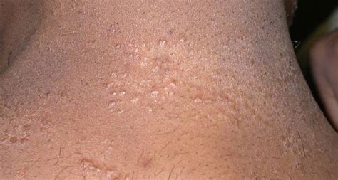 Sarcoidosis Cutaneous Sarcoidosis Dermatology Advisor