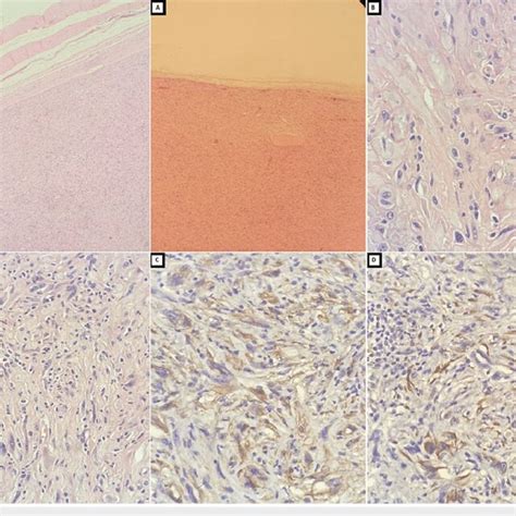 Histopathological Examination A A Well Circumscribed Cellular