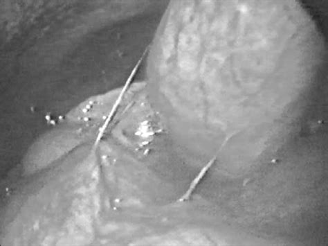 Laparoscopy Revealed Diffuse Peritonitis Download Scientific Diagram