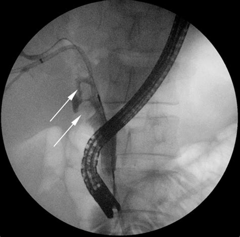 Percutaneous Cholecystostomy