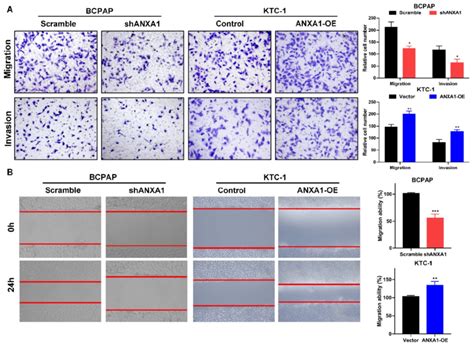 Anxa1 Promotes Cell Migration And Invasion Of Ptc Cells A The