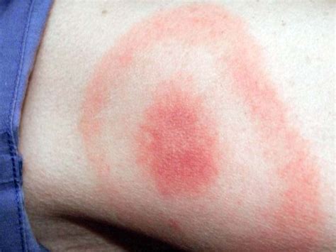 Chronic Lyme Disease Real Or Fake Complete Information Technology