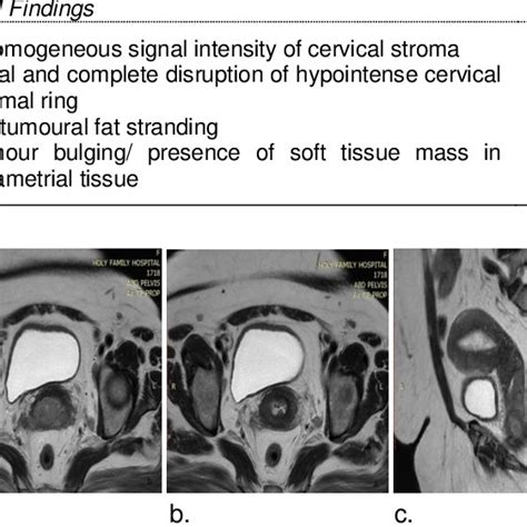 Pdf Diagnostic Accuracy Of Mri In Detecting Parametrial Invasion In