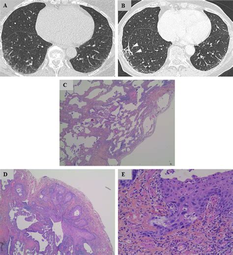 A B Chest Computed Tomography In Lung Windows Showing Posterior