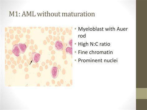Ppt Acute Myeloid Leukemias Aml Powerpoint Presentation Free