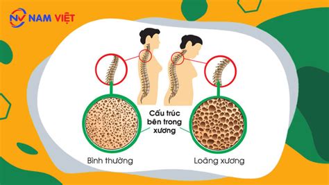 Bệnh Nhiễm độc Cadimi Nghề Nghiệp An Toàn Nam Việt