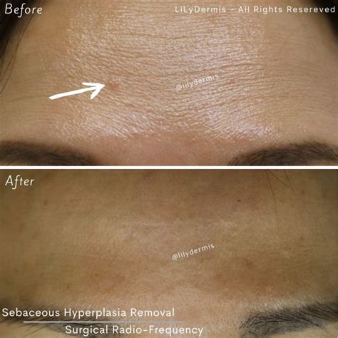 Sebaceous Hyperplasia Removal Lilydermis Calgary