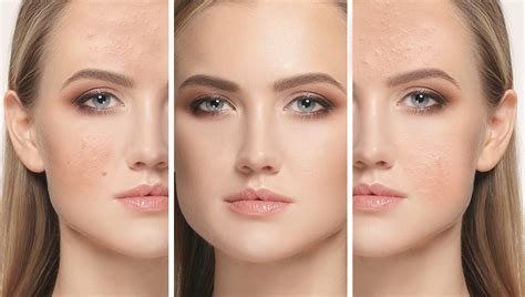 Azelaic Acid For Melasma Before And After Results Guide
