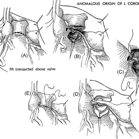 The Takeuchi Technique A The Aorta And Main Pa Are Incised As Shown