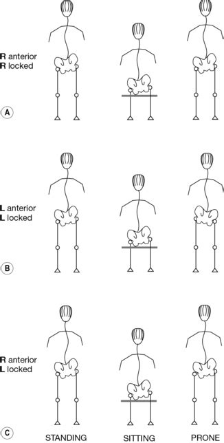 The Malalignment Syndrome Musculoskeletal Key