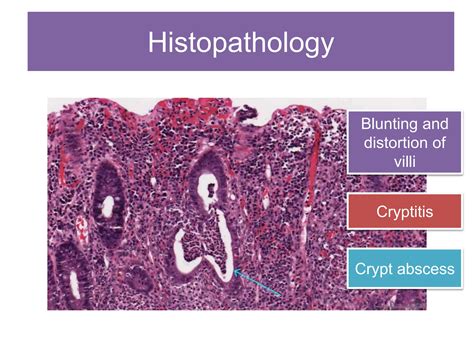 Ulcersoftheintestinepatjology170305141940pptx
