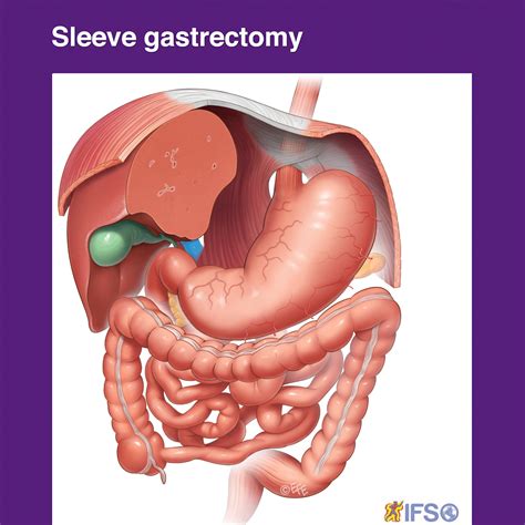 Gastric Sleeve Surgery Melbourne Northern Surgical Care