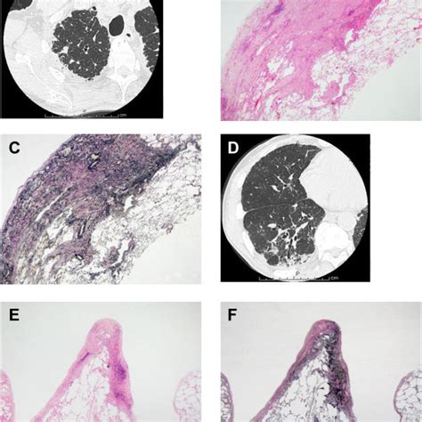 Comparison Of Fibroelastosis Between The Upper And Lower Lobes In A