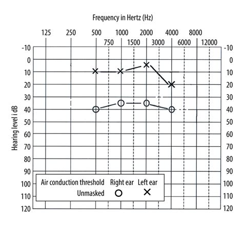 The Pure Tone Audiometry Pta Of The Right And Left Ear Y Axis Is The Download Scientific