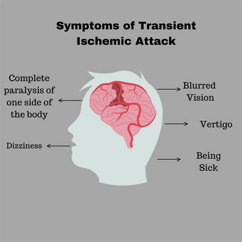 Ppt Transient Ischemic Attack Tia Symptoms Causes And More