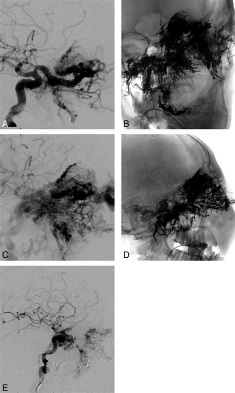 Safety And Clinical Efficacy Of Onyx For Embolization Of Extracranial
