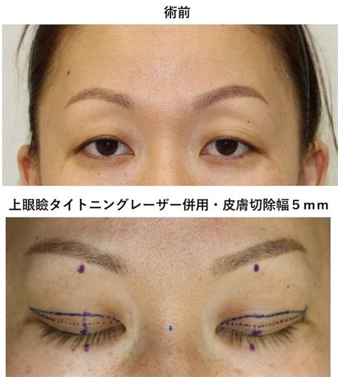 上まぶたのたるみ改善 みかこクリニック Mikako Clinic （形成外科美容外科美容皮膚科）一宮駅東口徒歩1分