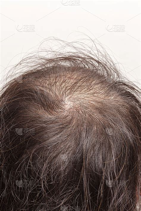 头发脱落，秃掉