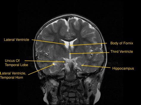 Ppt Mri Of Brain Head And Neck Powerpoint Presentation Free Download
