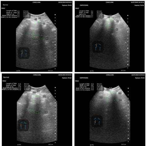 Lung Ultrasound An Initial Bedside Spirometry Tool In Diagnosing
