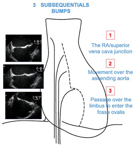 Transeptal Puncture Complications What To Watch For And How To Avoid Them