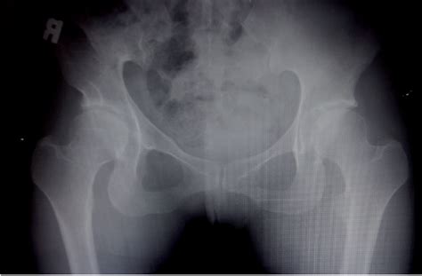 Figure 4 From Triple Pelvic Osteotomy For The Treatment Of Symptomatic