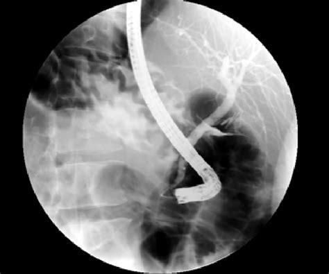 Radiographic Finding During ERCP Intervention Common Bile Duct Is Download Scientific Diagram
