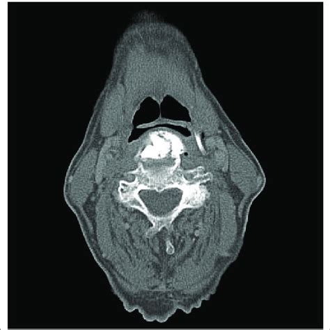Ct Sagittal Scan Showing Anterior Osteophytes And Ossification Of