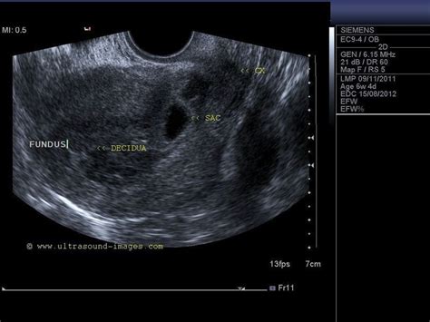 Lscs Scar Pregnancy Pregnancy Early Ectopic Pregnancy Pregnancy