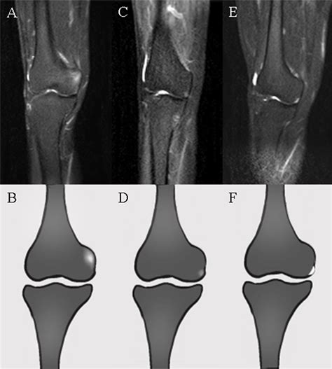 Frontiers Peripheral Enthesitis Assessed By Whole Body Mri In Axial