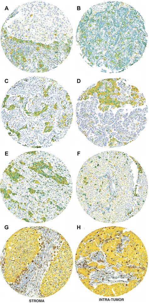 Multiplexed Protein Detection Using Translucent Ihc Chromogens For Tam