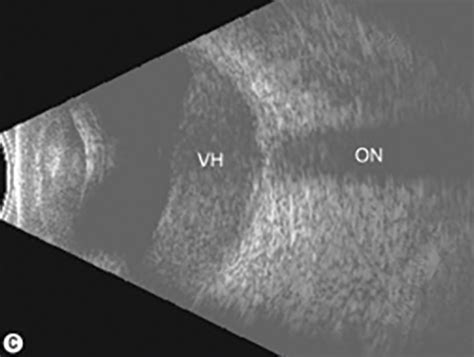 Vitreous Hemorrhage Observe Or Operate Retina Today