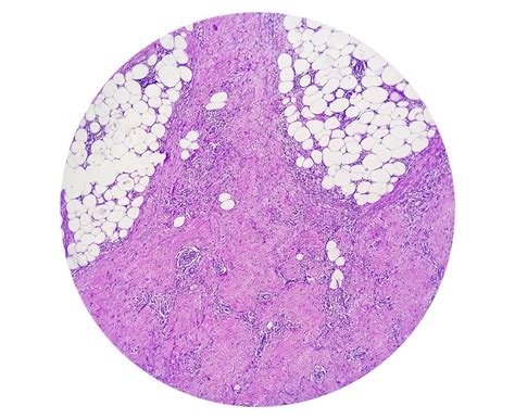 Premium Photo Photomicrograph Of Granulomatous Tissue Histology