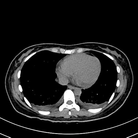 Choledocholithiasis And Choledochal Cyst Radiopaedia 79452 92568 Axial Cholangiogram Nc Commons