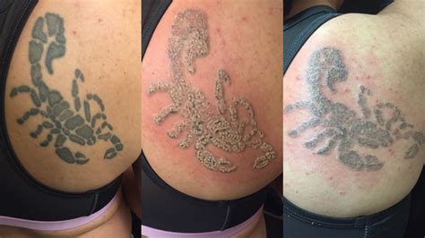 Tattoo Entfernen