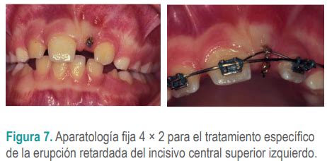 Ortodoncia Interceptiva Técnica 4 × 2 Odontogénesis