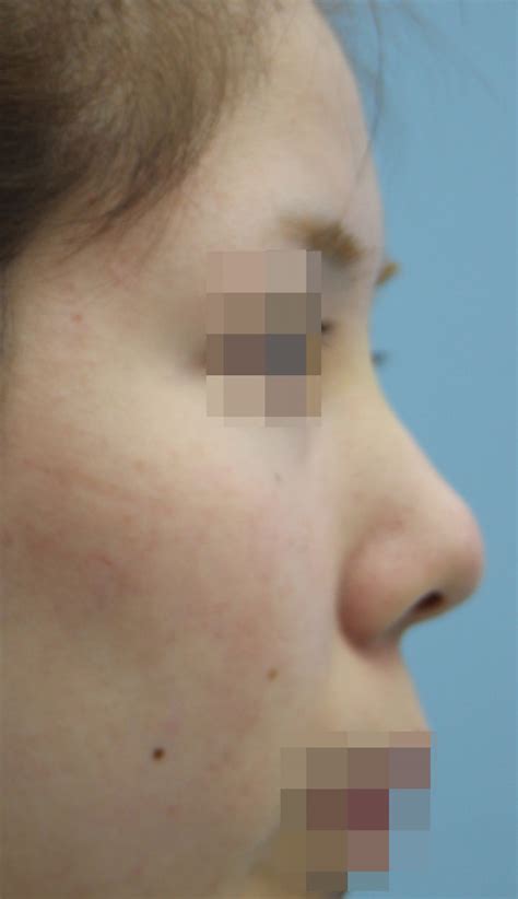 正面も横顔も美しい鼻中隔延長 ヤスミクリニック美容整形情報案内 美容外科手術を受ける人のために