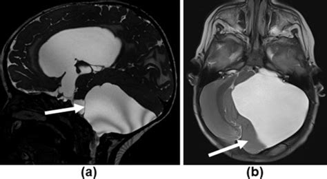 Not Dandy Walker Variant A Review Of Prominent Retrocerebellar Csf