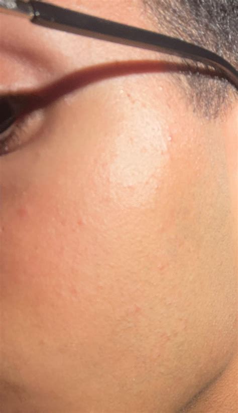 How To Fix All Of These There Are More Pimples Spots That I Had