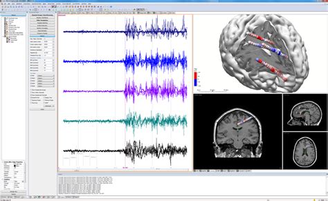 Curry Epilepsy Seeg Butterfly Plot Compumedics Neuroscan