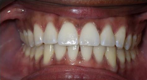 Clear Aligners Ulab Orthodontist Toronto Invisalign Provider